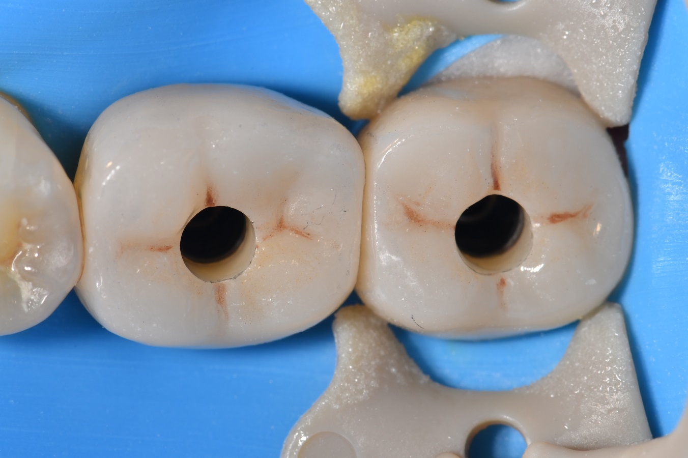 Implant Screw Access Direct Composite Closures