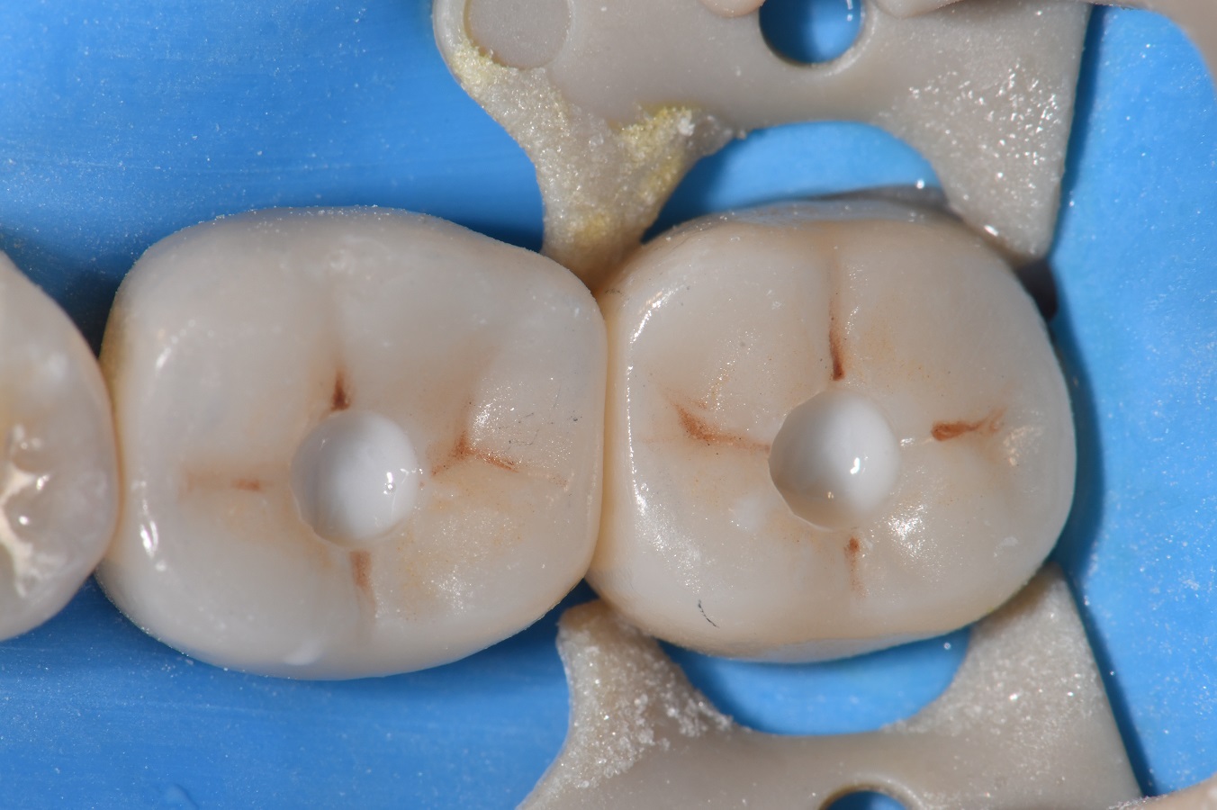 Implant Screw Access Direct Composite Closures