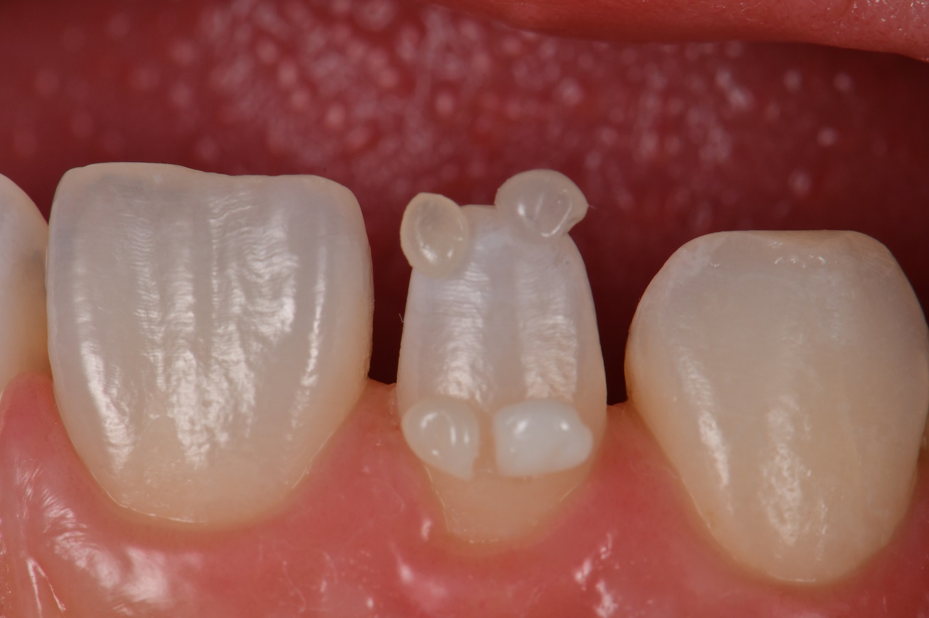 Peg Lateral Incisor Composite Layering