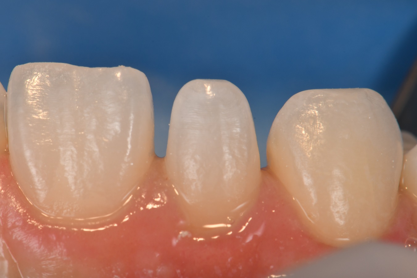 Peg Lateral Incisor Composite Layering