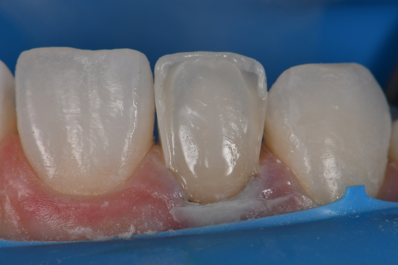 Peg Lateral Incisor Composite Layering