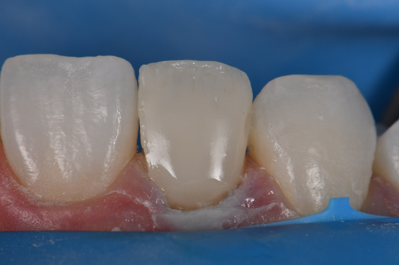 Peg Lateral Incisor Composite Layering