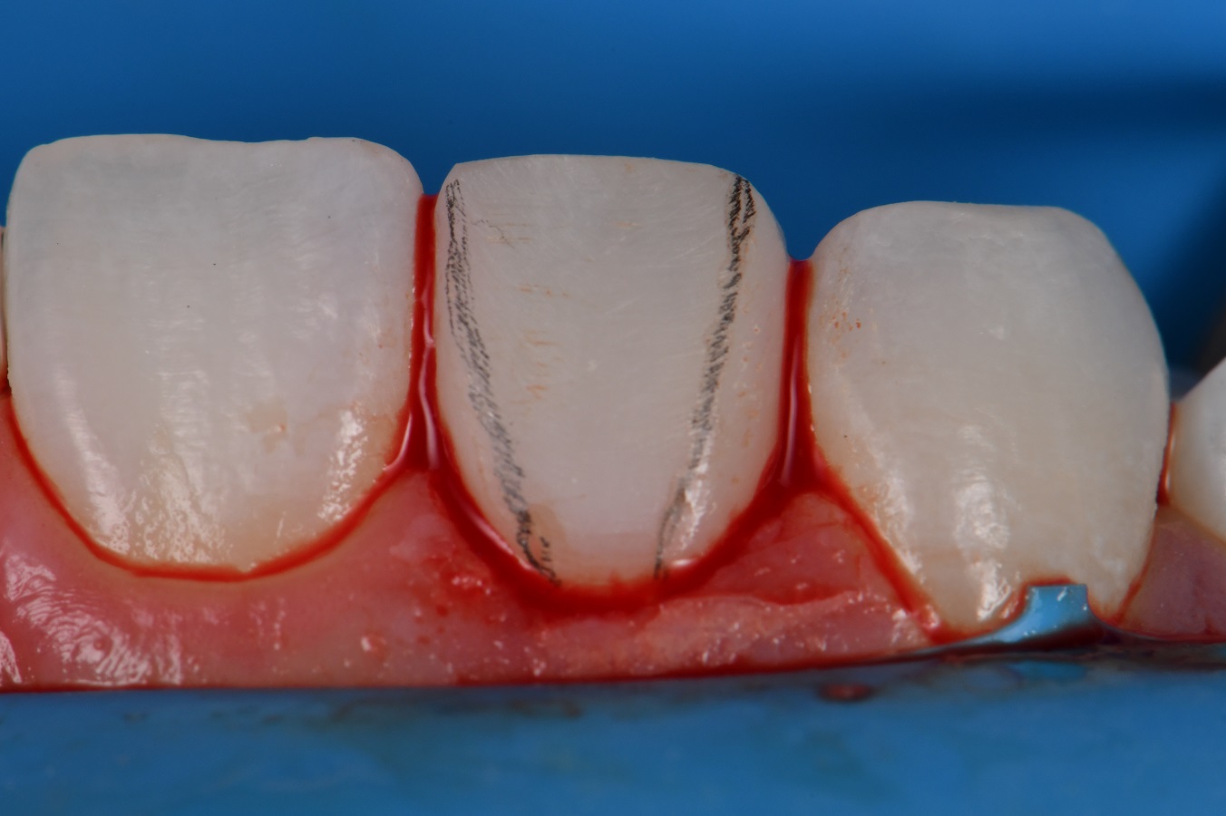 Peg Lateral Incisor Composite Layering