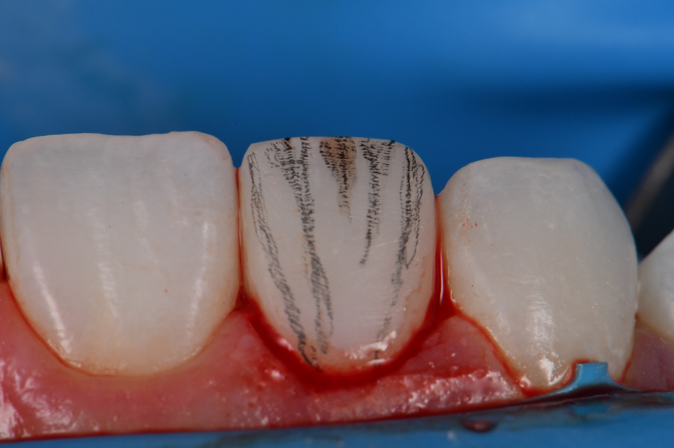 Peg Lateral Incisor Composite Layering