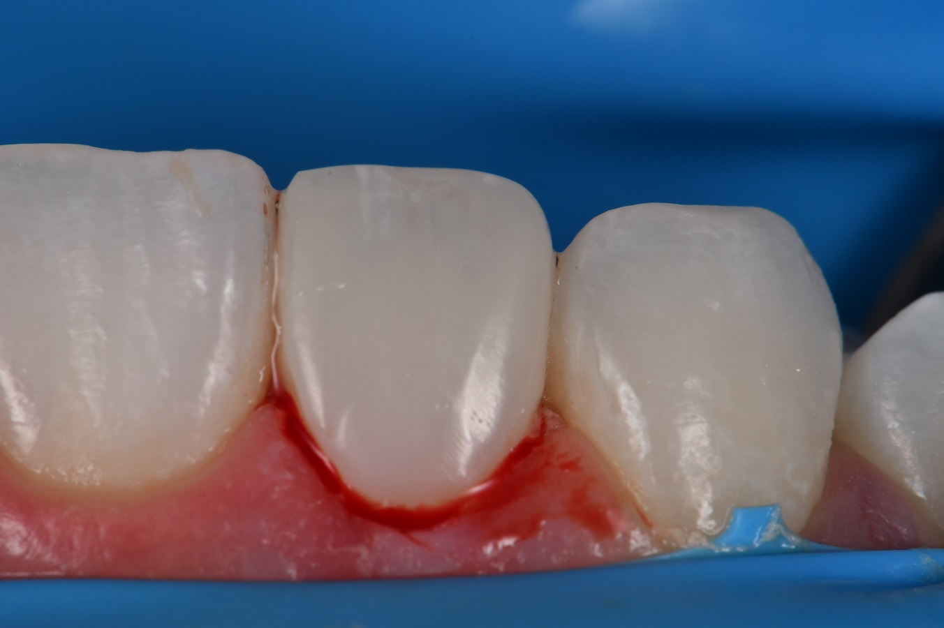 Peg Lateral Incisor Composite Layering