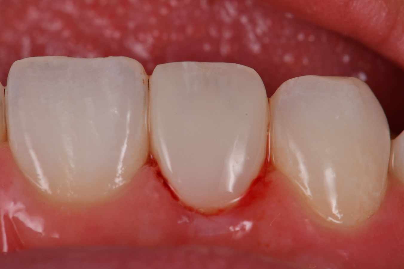 Peg Lateral Incisor Composite Layering