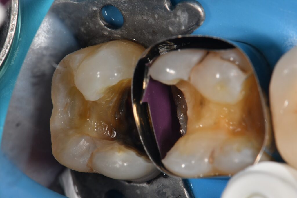 Matrix in matrix technique using Simplishade and Garrison Compositight