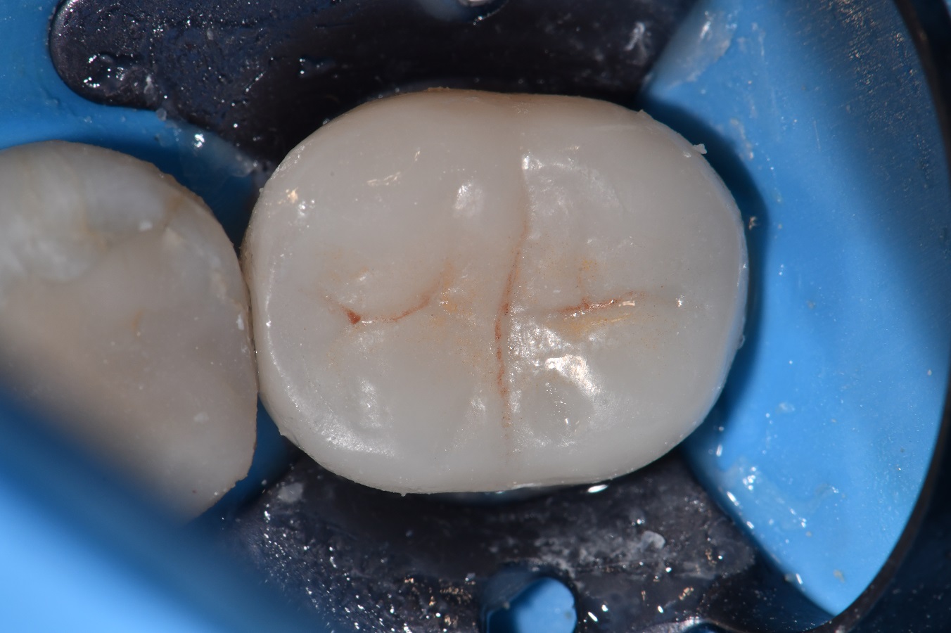 Conservative Crown for a Broken Down Molar