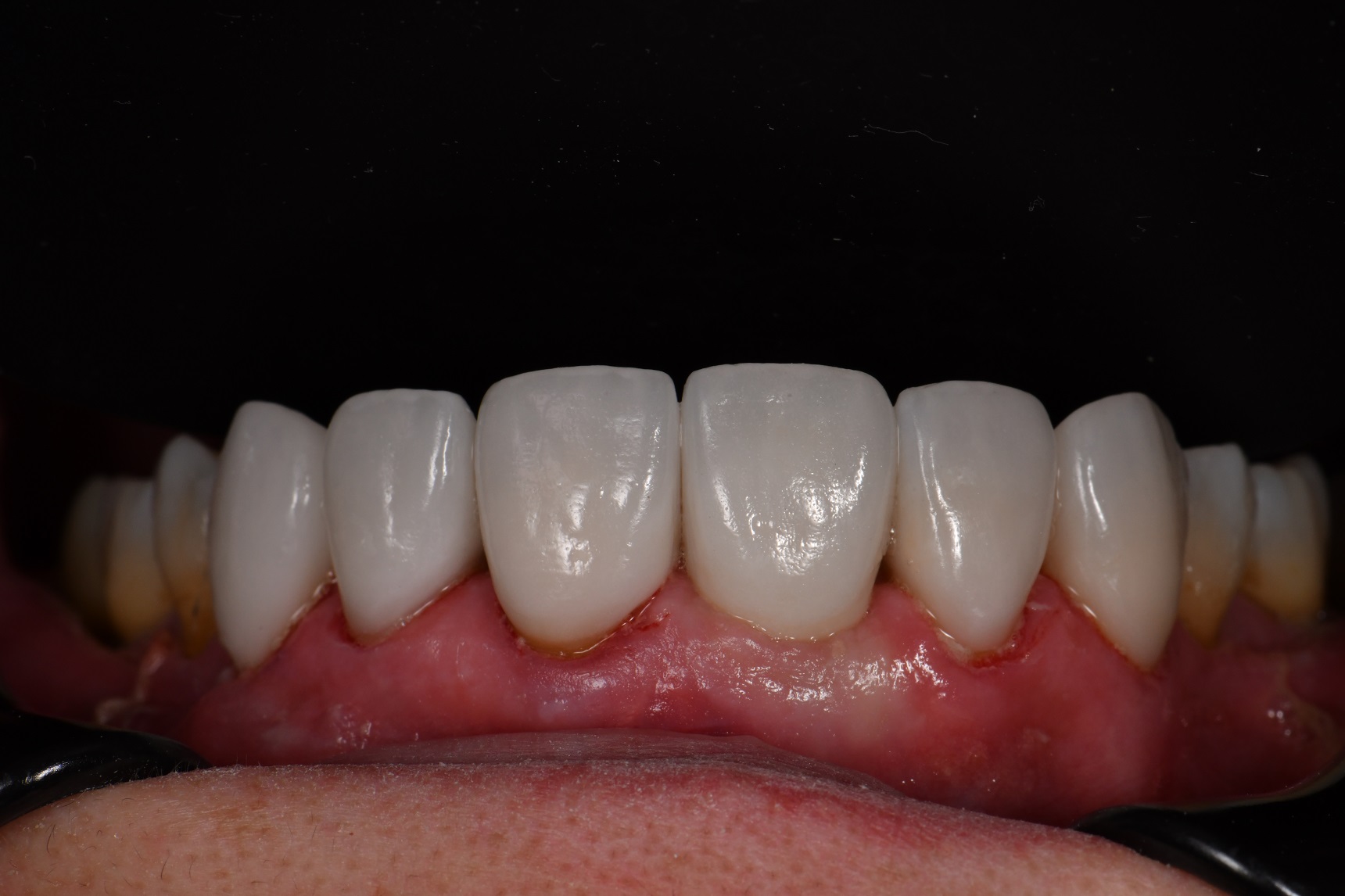 Social Six dentistry to enhance the smile with a limited budget