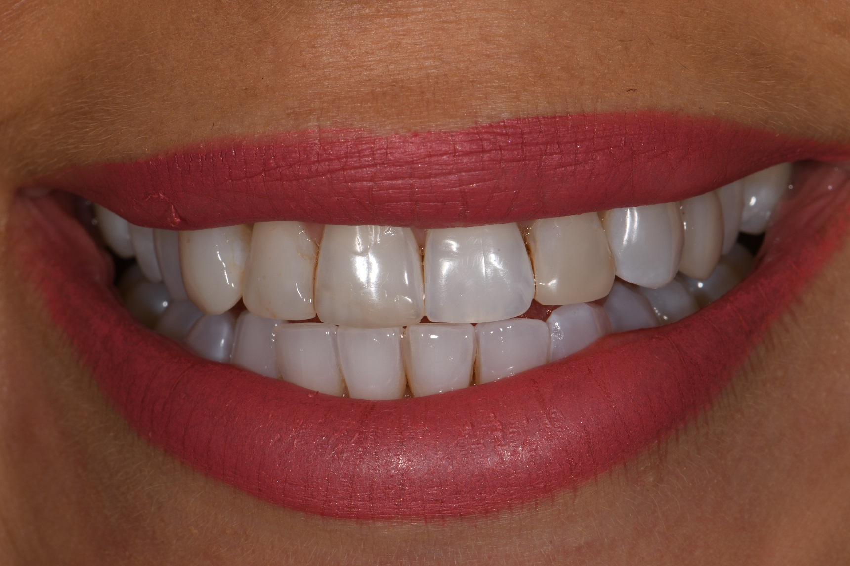 Boosting your smile with natural dental esthetics