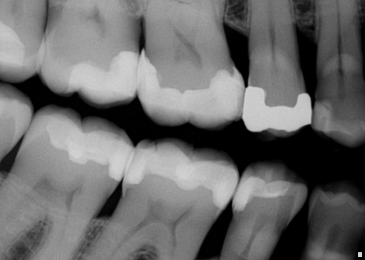 Complex carefully layered quadrant composite restorations