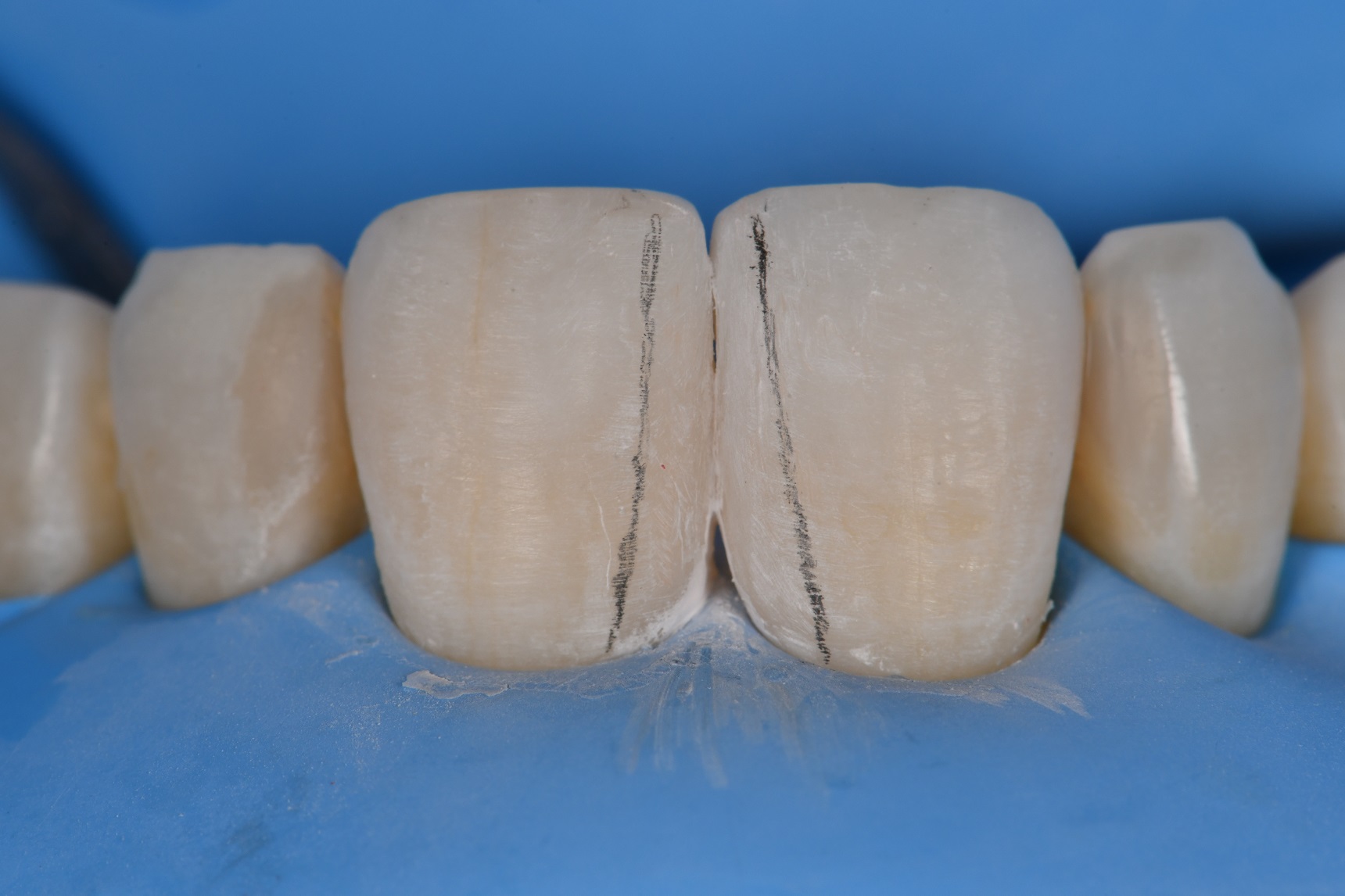 Supercomposite use in black triangle closure