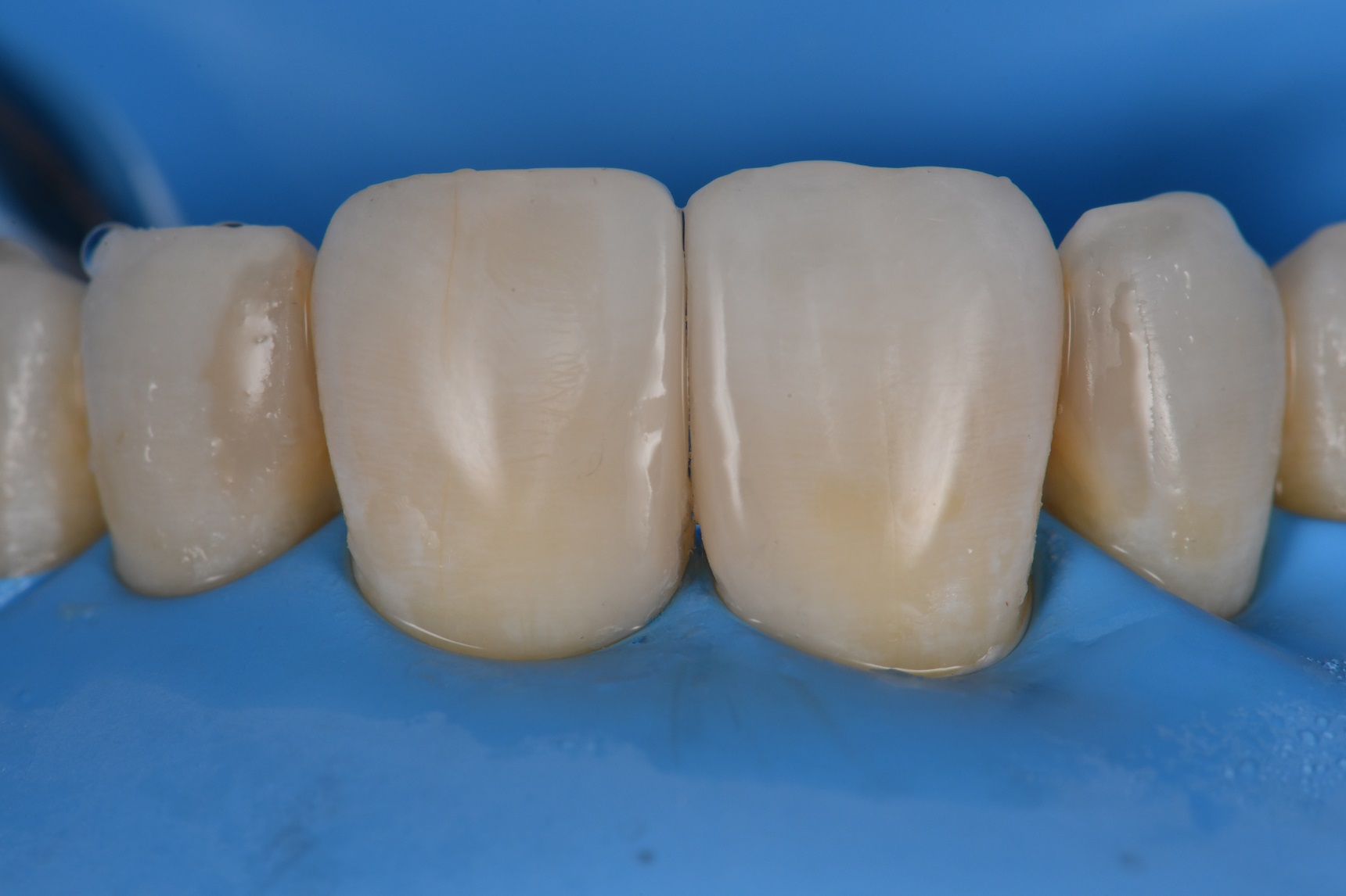 Supercomposite use in black triangle closure