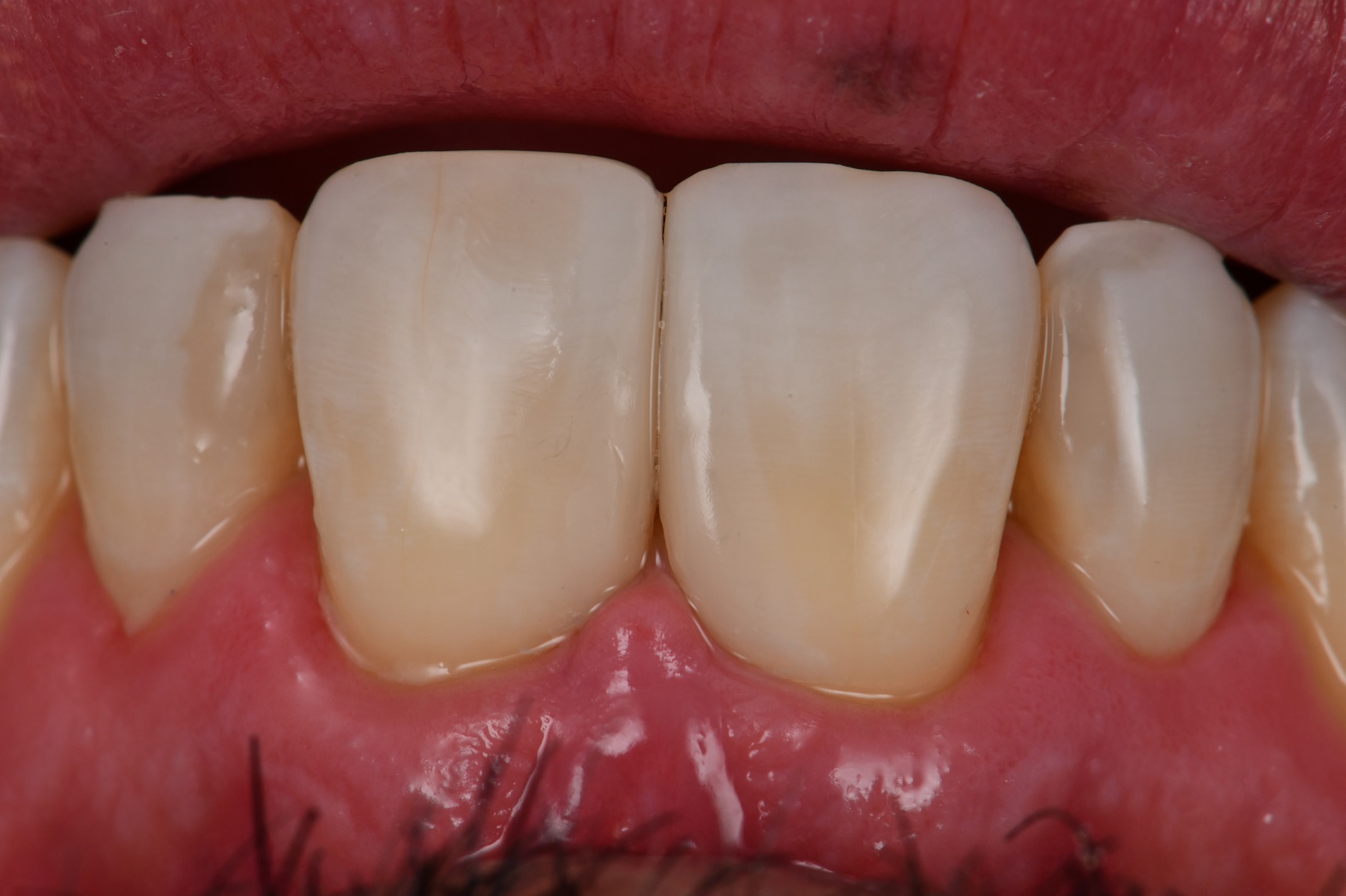 Supercomposite use in black triangle closure
