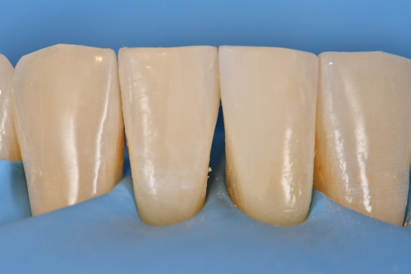 Black Triangle Closure using Garrison Varistrips