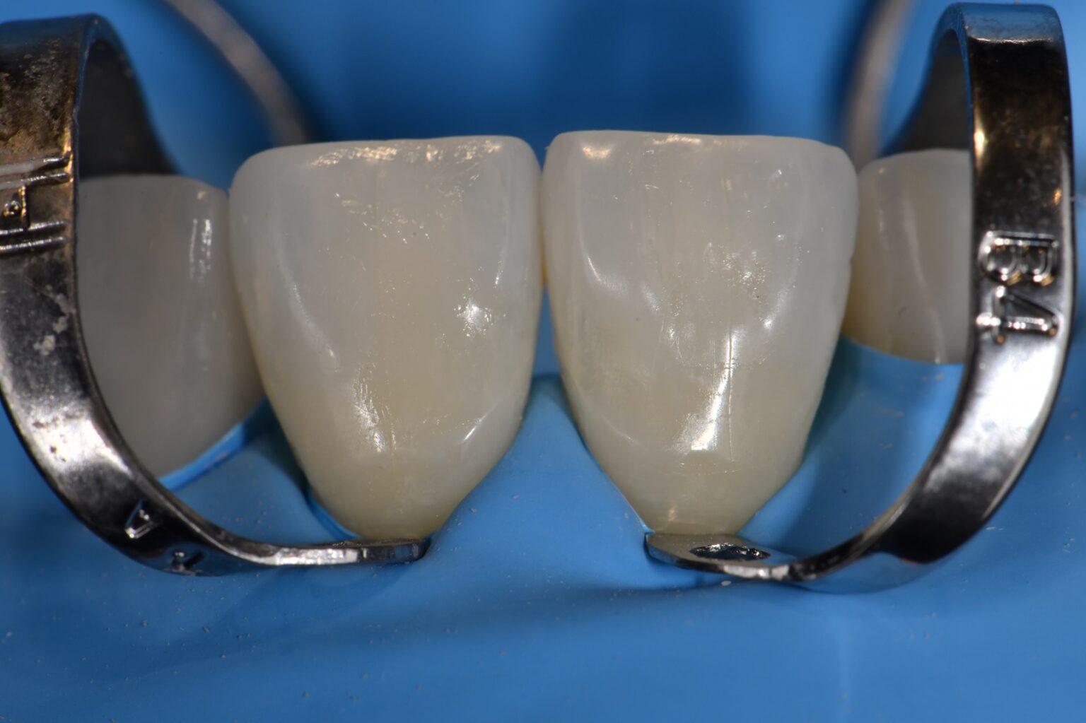 Subtle resin additions to even out enamel texture