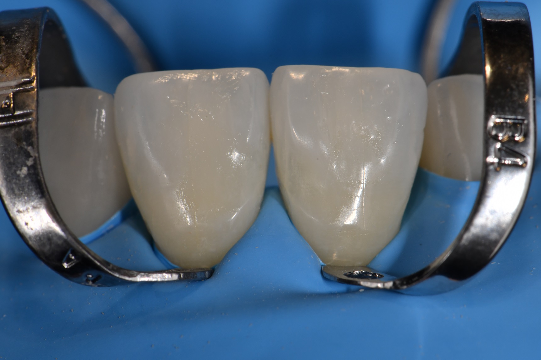 Subtle resin additions to even out enamel texture