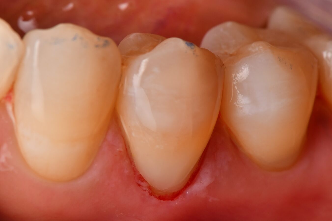 Class V restoration to eliminate abrasion and tetracycline-based hypoplasia