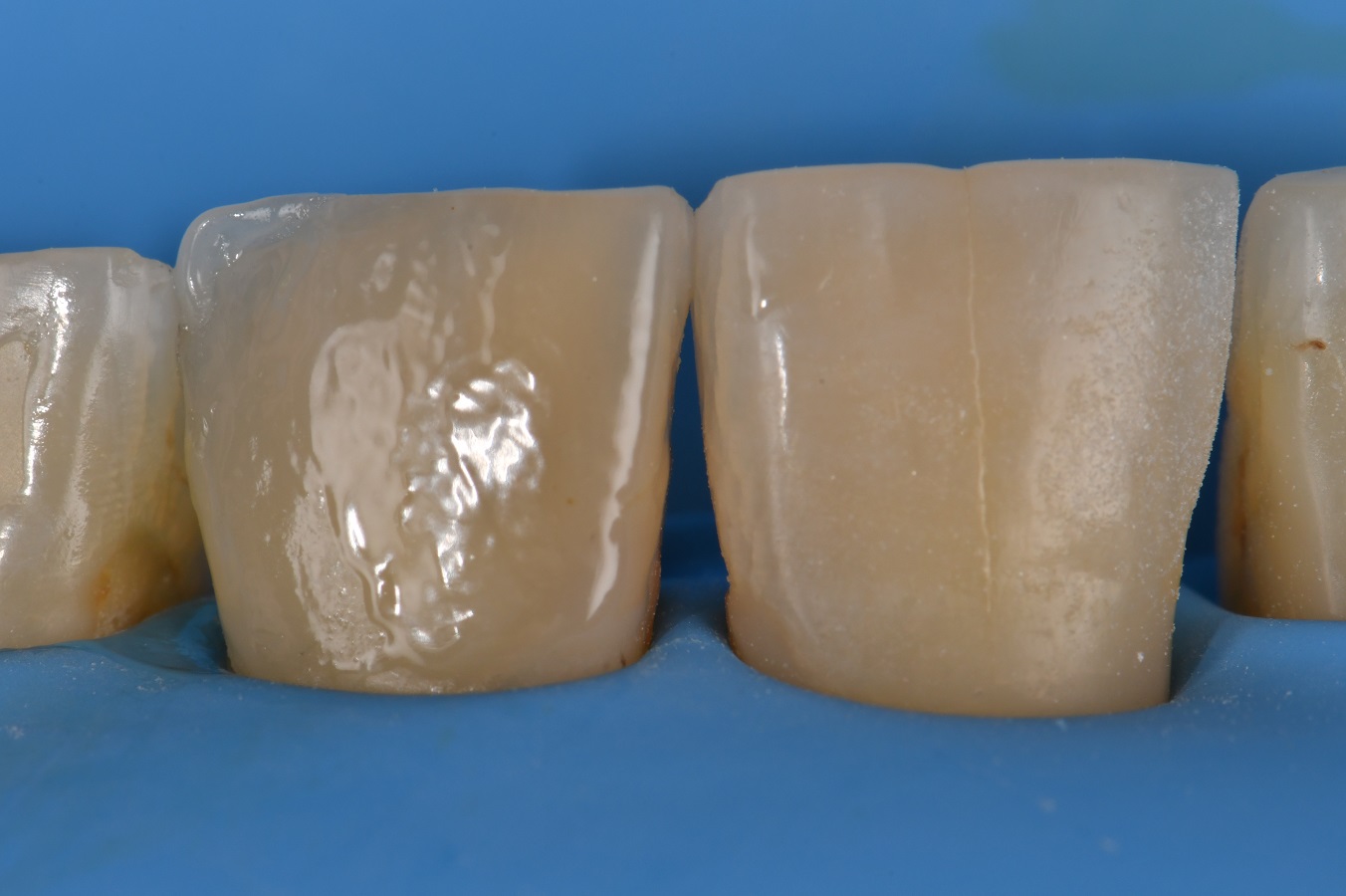 small simple composite layered restorations