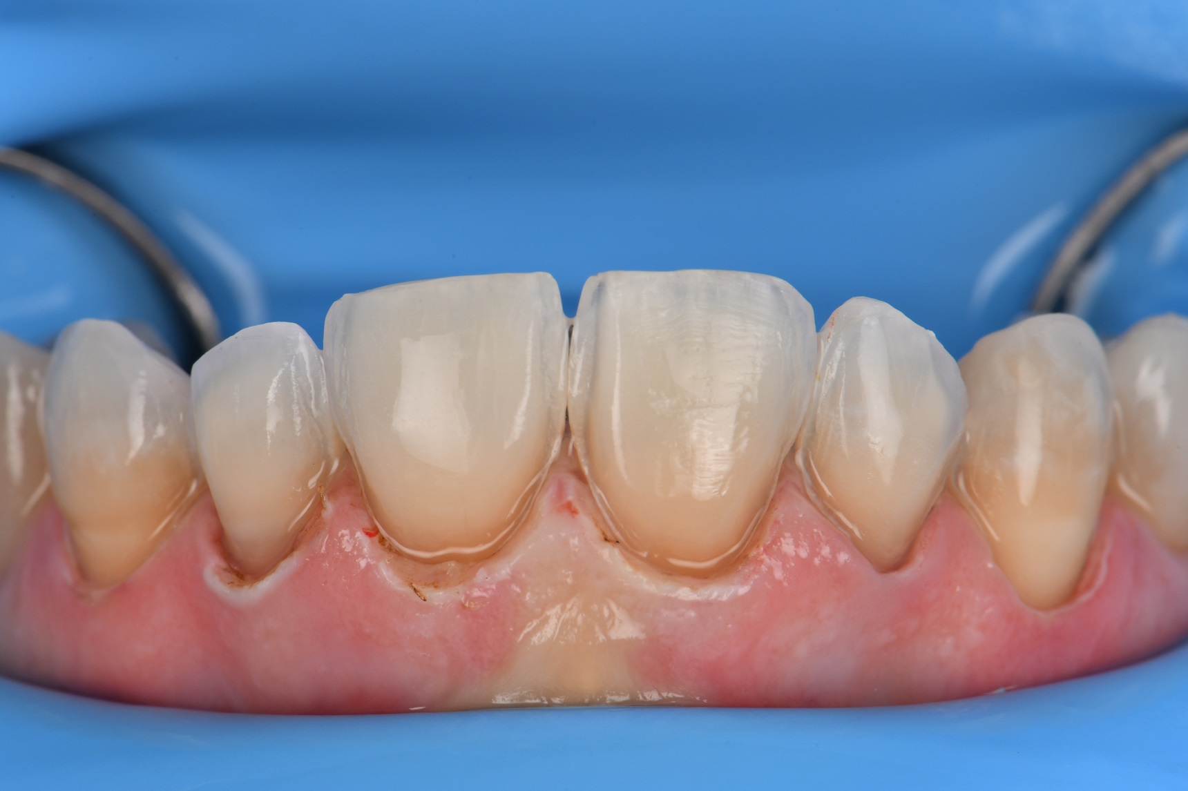 Preparation and Gingivectomy Workflow