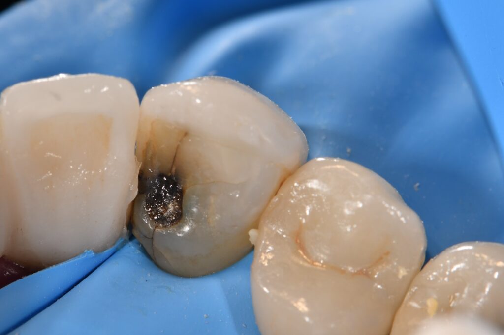 Amalgam incompatibility with tooth structure