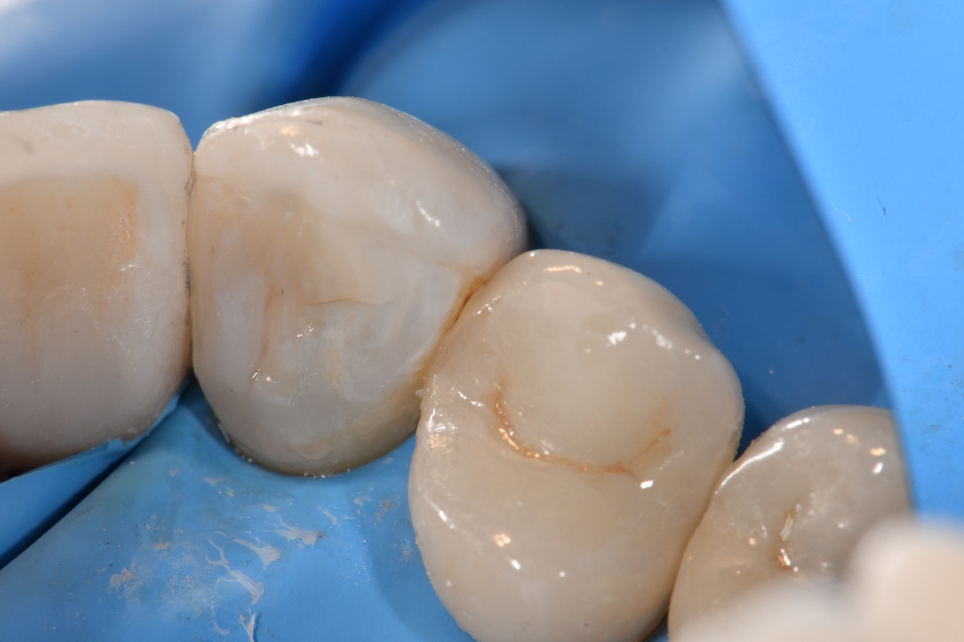 Amalgam incompatibility with tooth structure