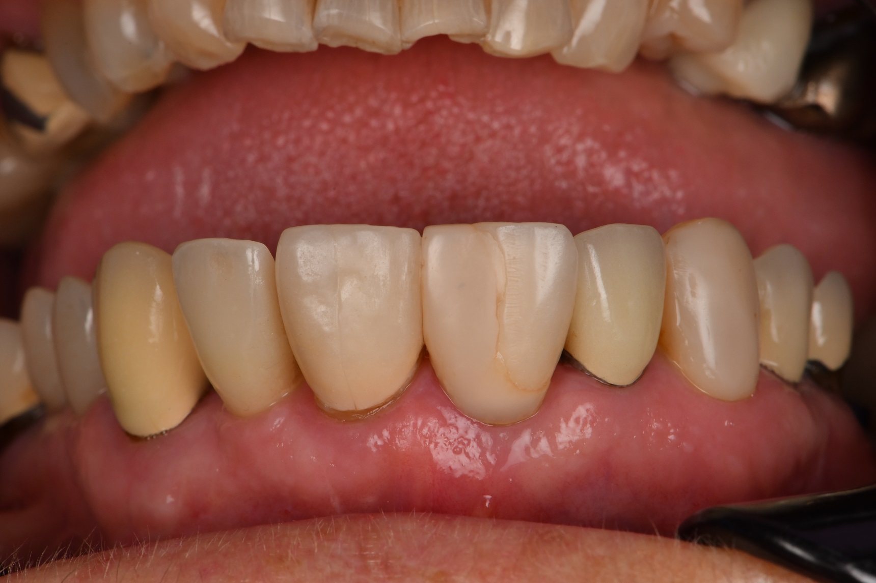Reconstruction within a dental reconstruction