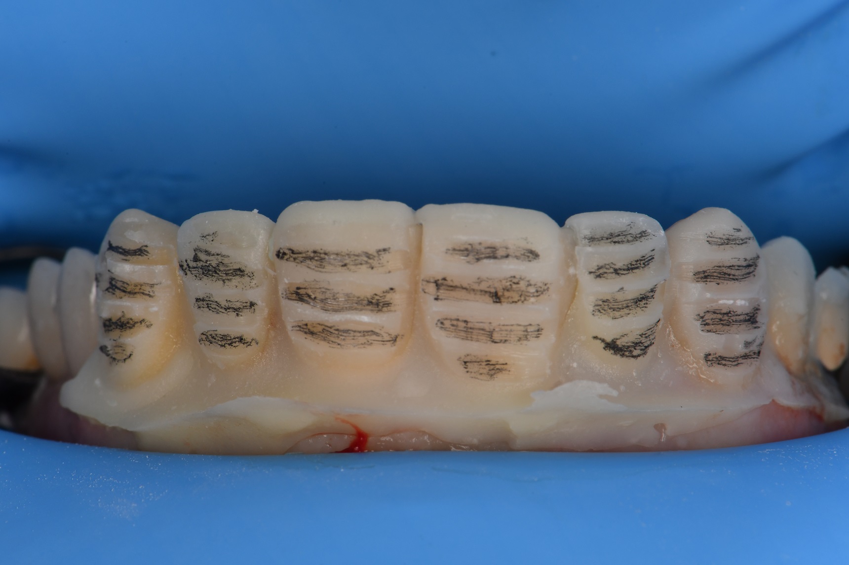 Reconstruction within a dental reconstruction