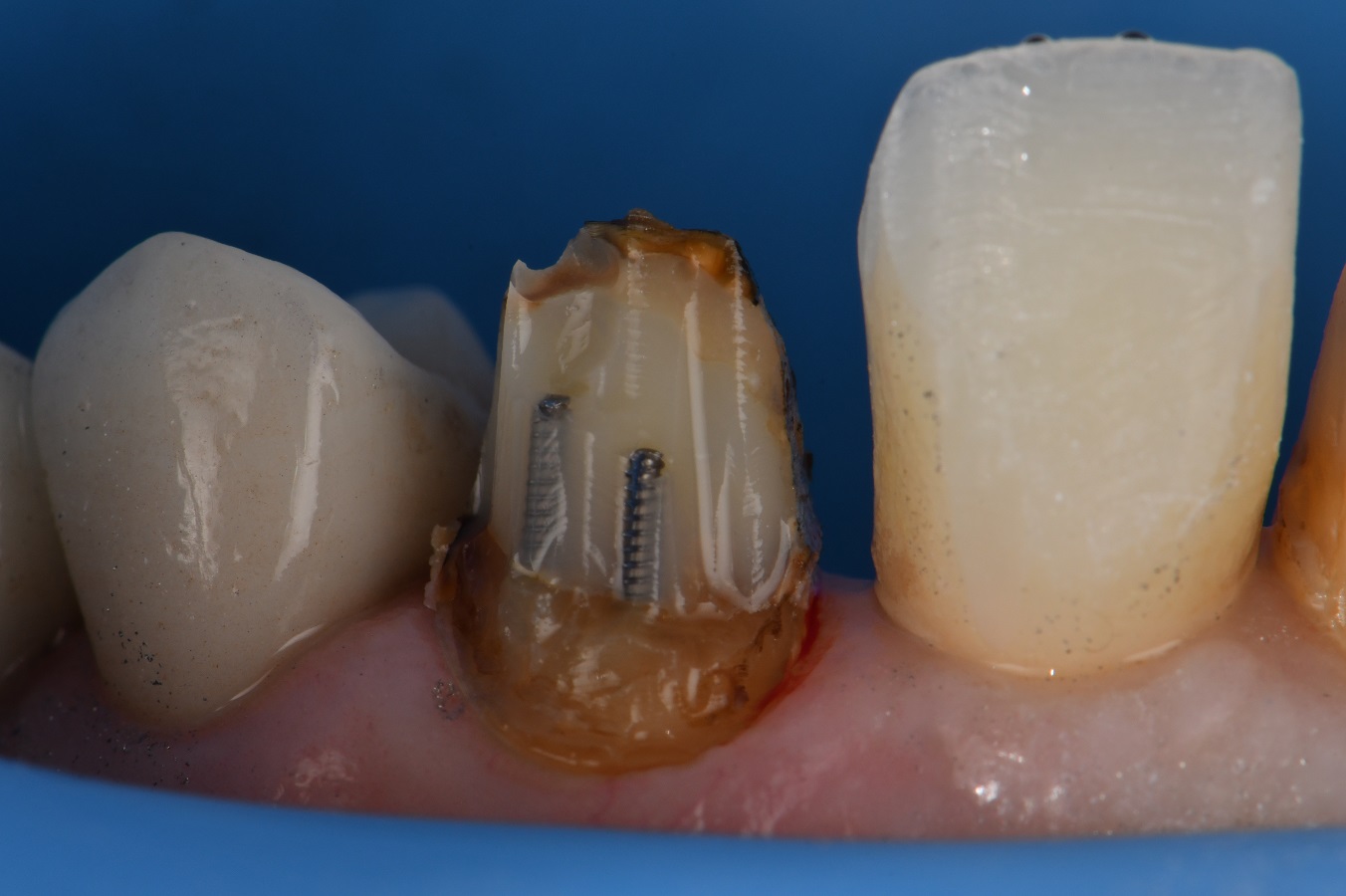 Reconstruction within a dental reconstruction
