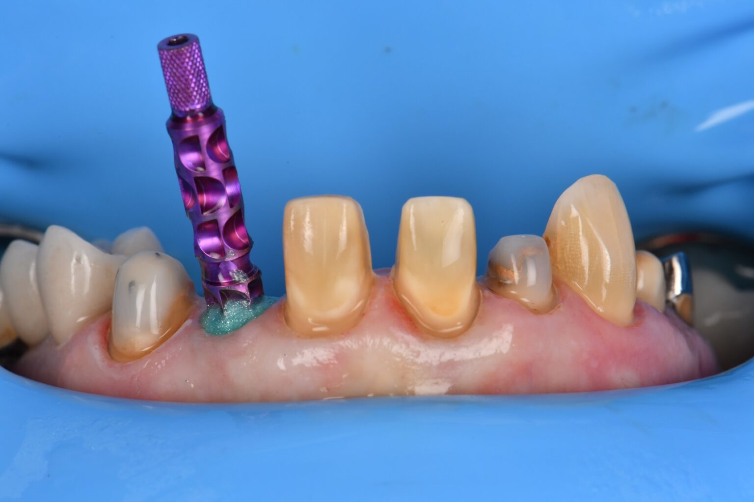 Reconstruction within a dental reconstruction
