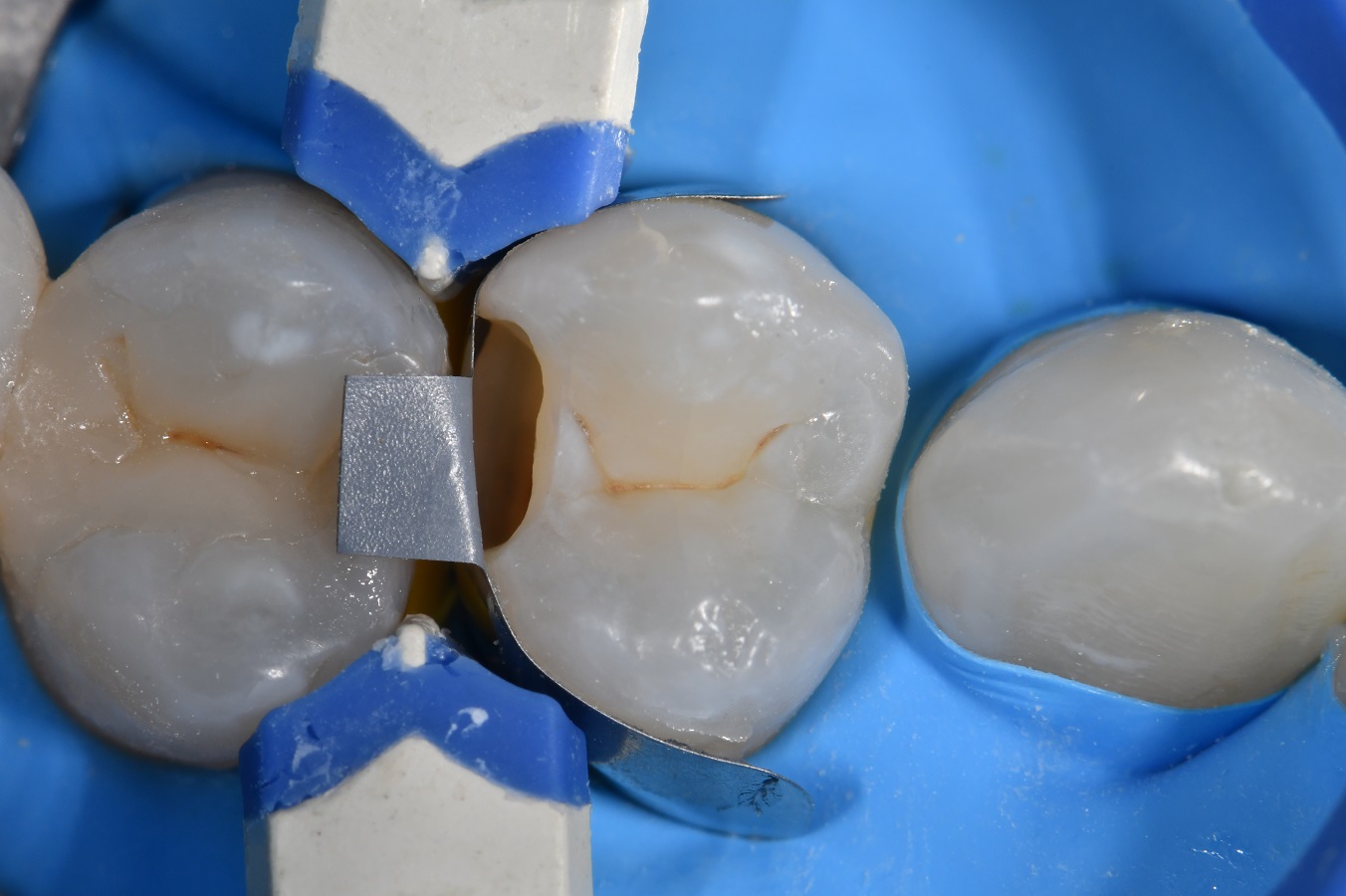 Using the Ceramic Rosebud Komet Burs to remove caries