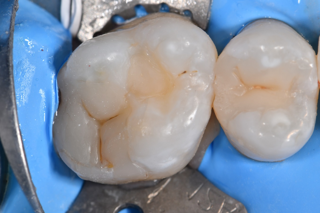 Shallow Simple Class I