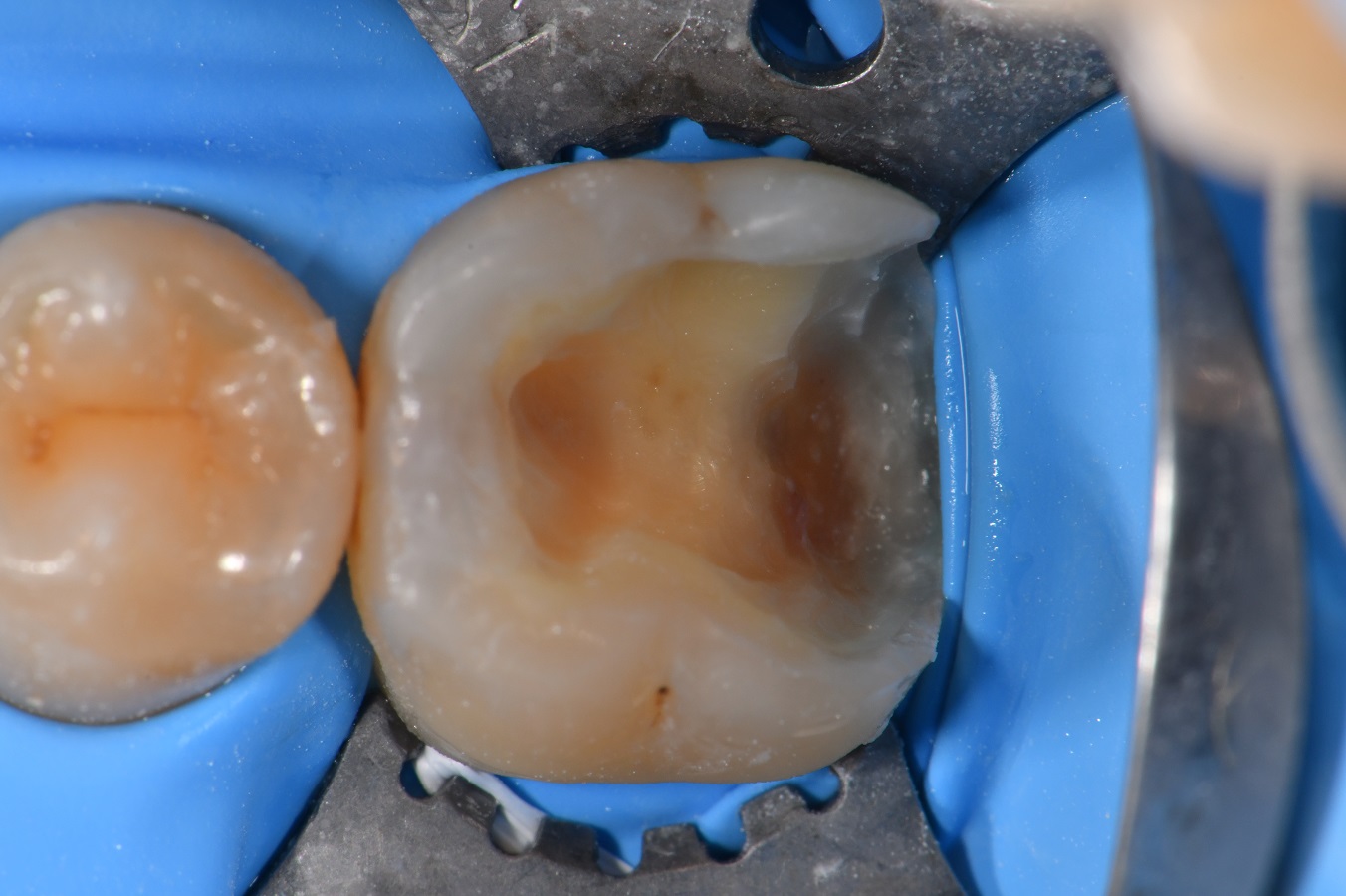Using the matrix in matrix assembly on a clamped tooth