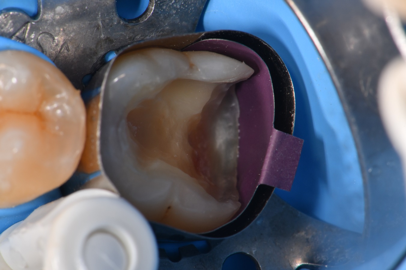 Using the matrix in matrix assembly on a clamped tooth