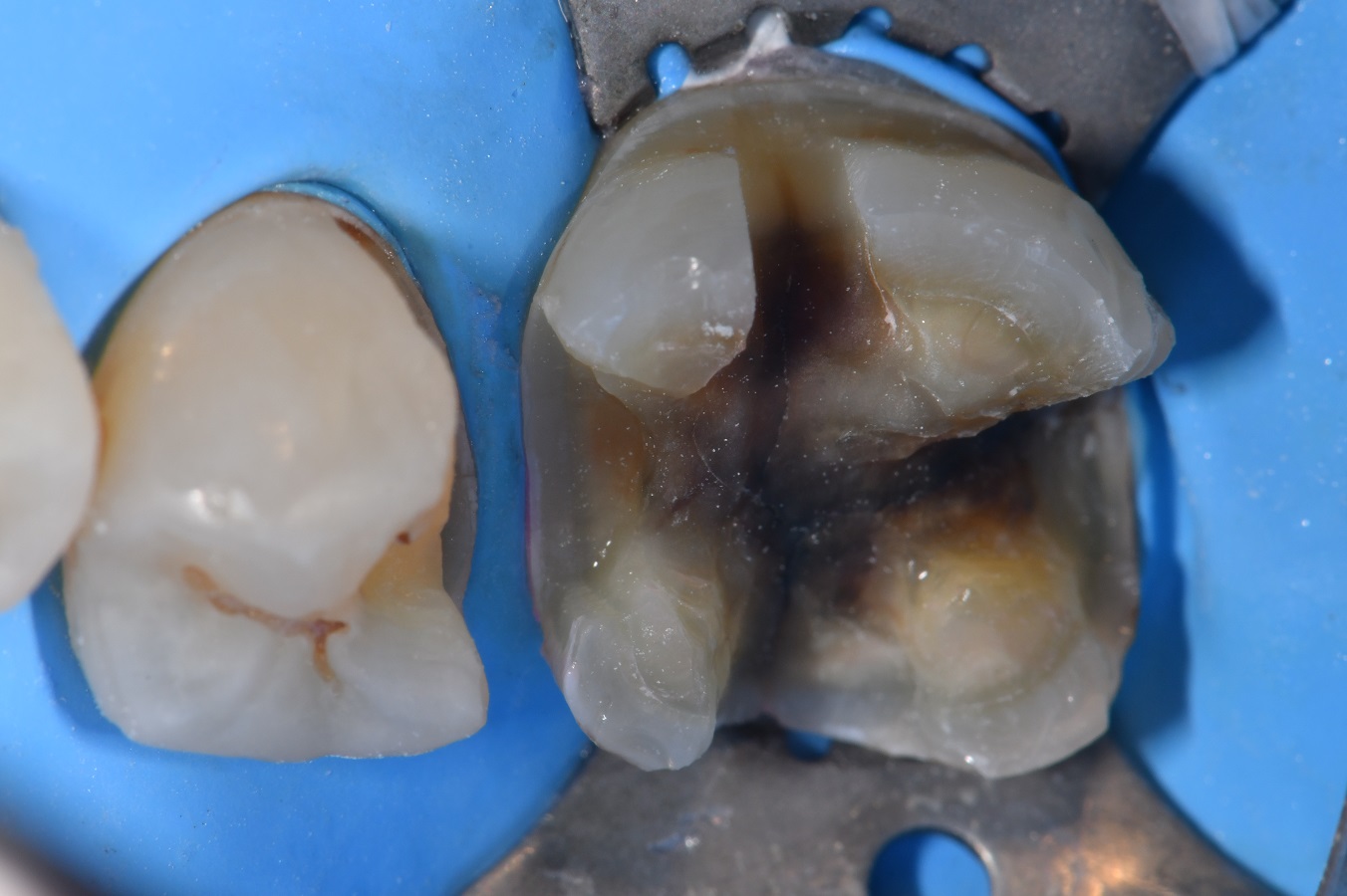 Chasing cracks and caries when reconstructing teeth