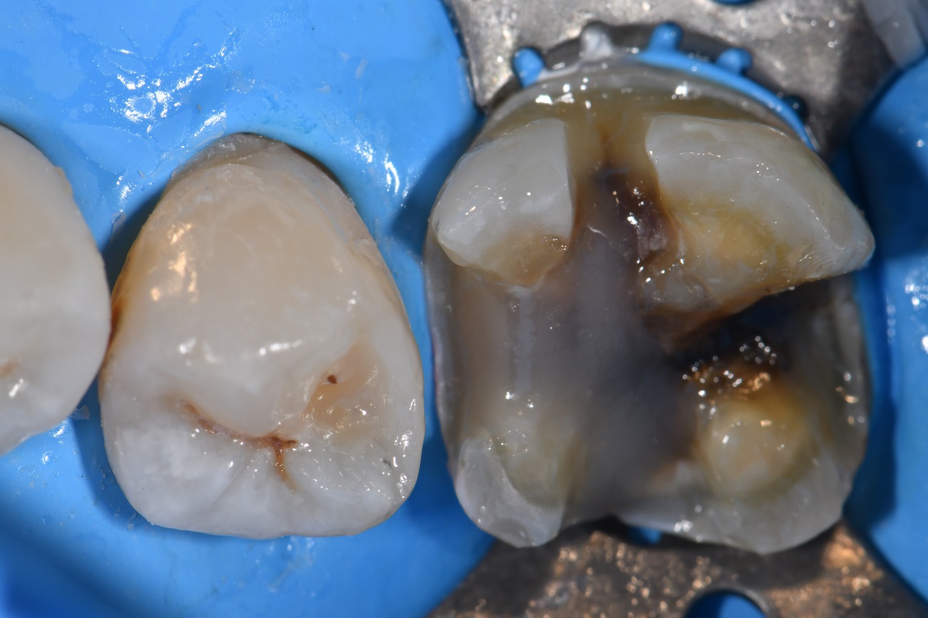 Chasing cracks and caries when reconstructing teeth