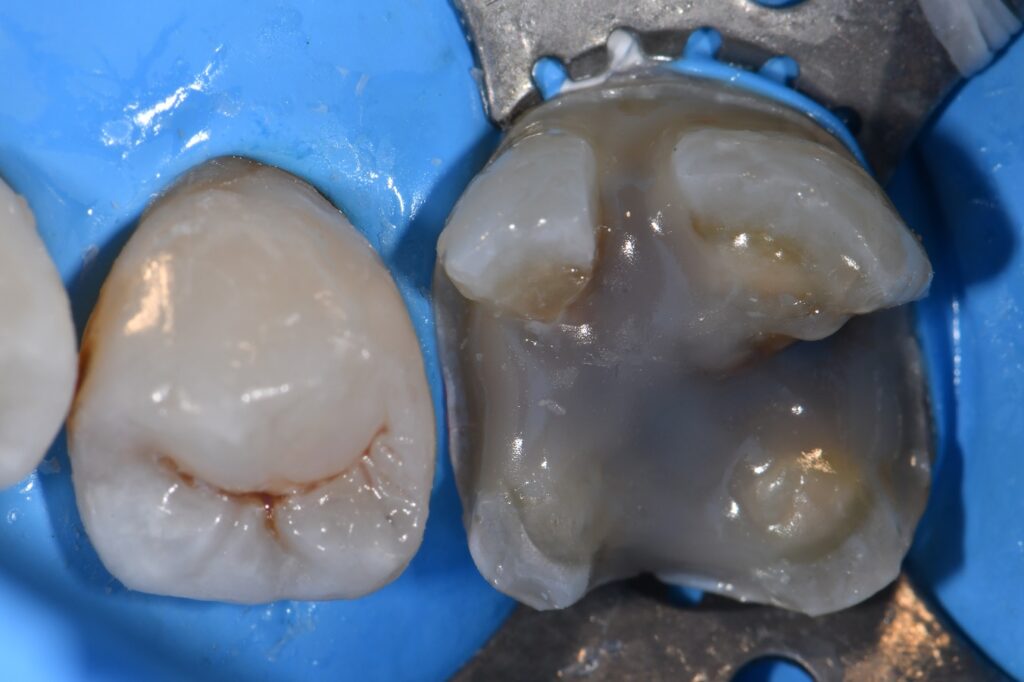 Chasing cracks and caries when reconstructing teeth