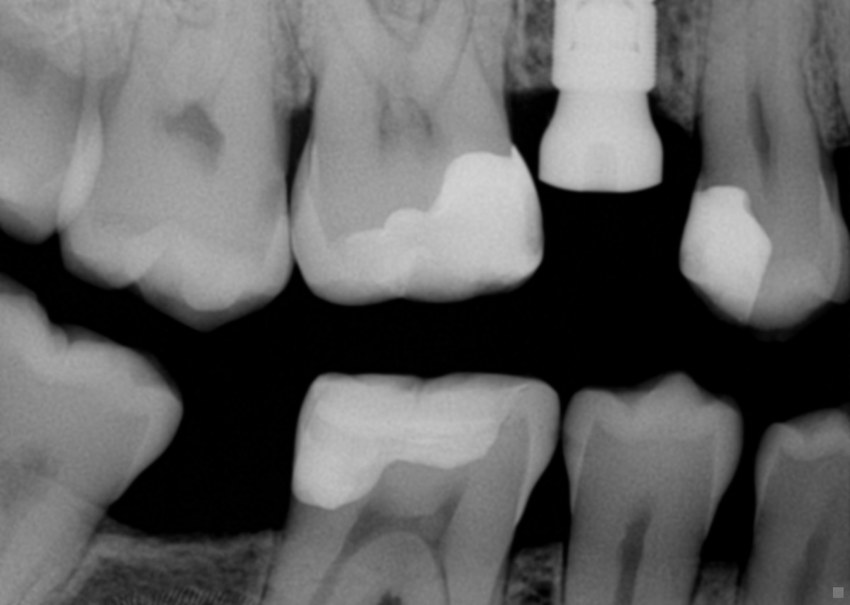 Using the matrix in matrix assembly on a clamped tooth