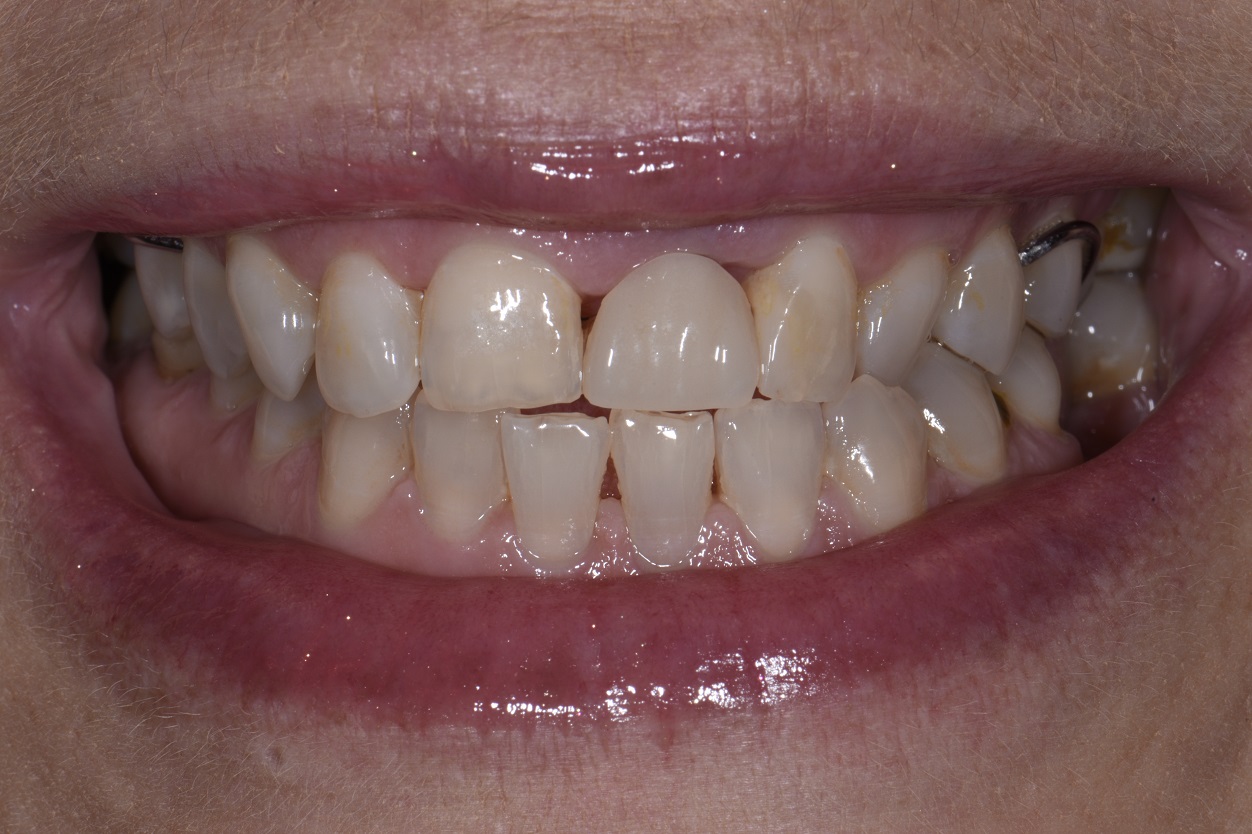 Smile Reconstruction with Pre-Prosthetic Orthodontics