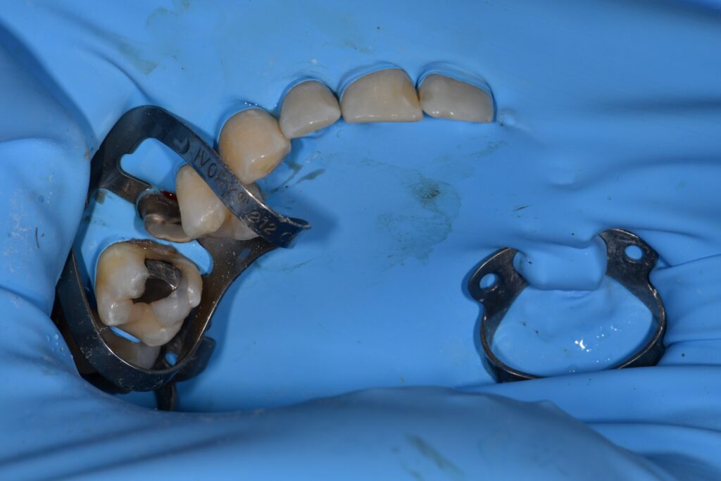 Dental Heroics Ferrule increase via crown lengthening on a bicuspid