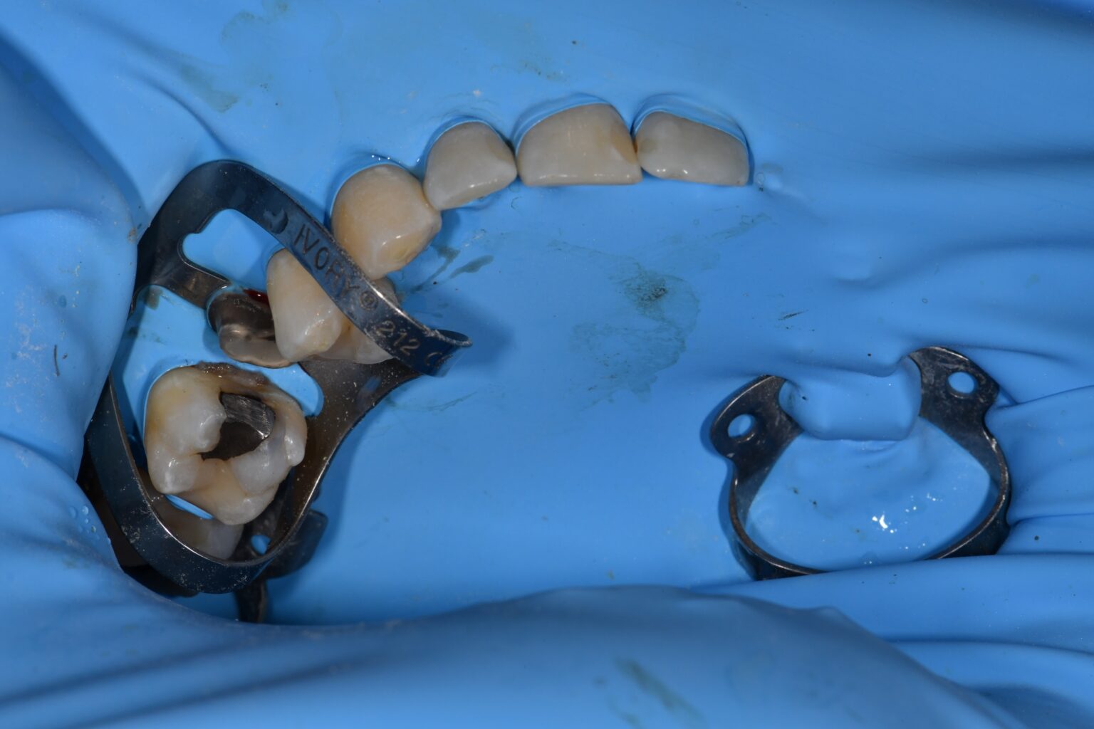 Dental Heroics Ferrule increase via crown lengthening on a bicuspid