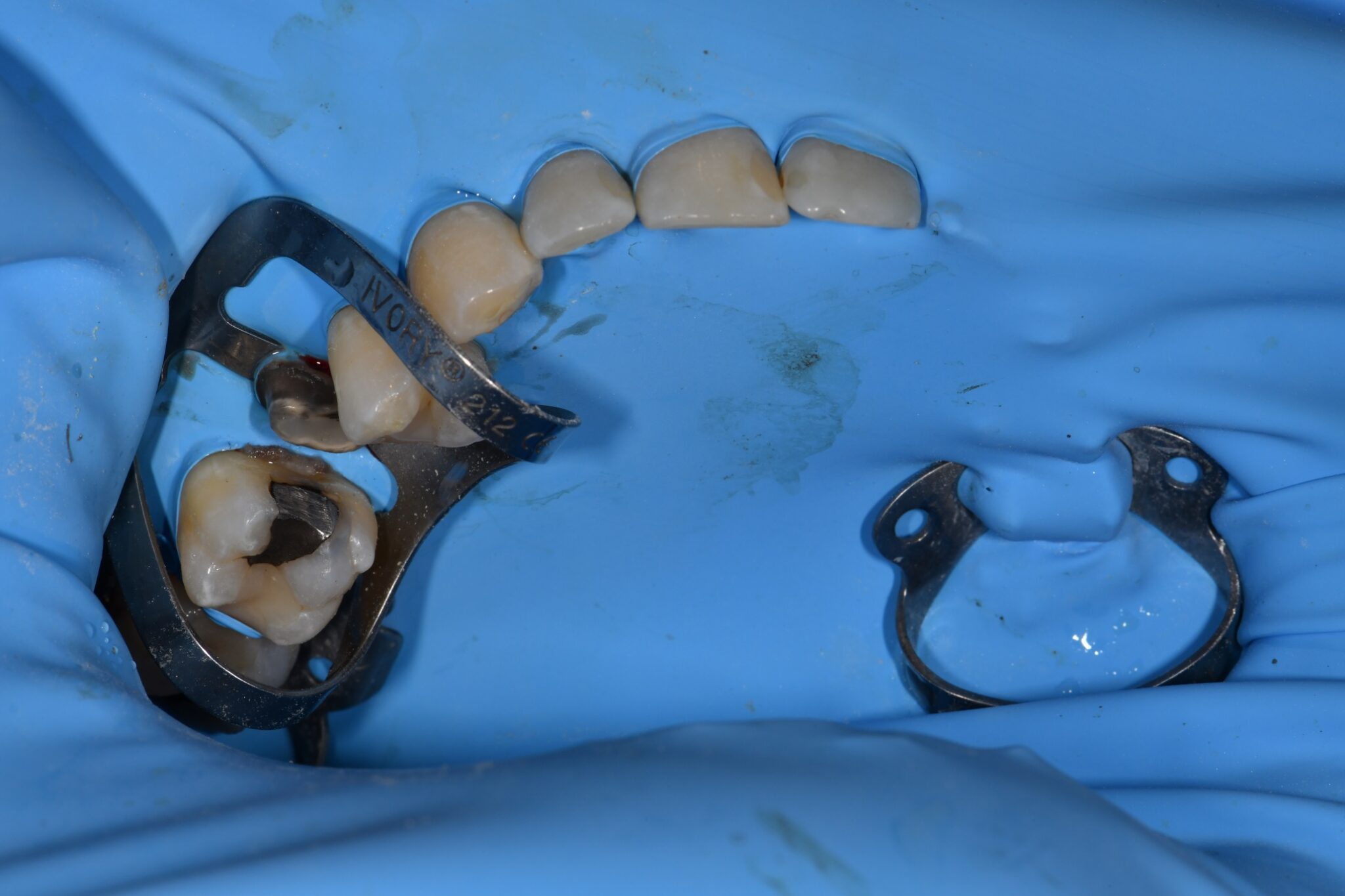 Dental Heroics Ferrule increase via crown lengthening on a bicuspid