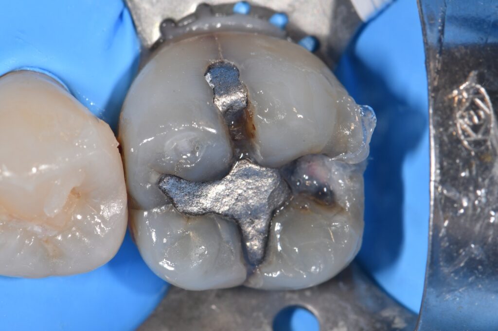 Chasing Cracks in Amalgam-filled teeth