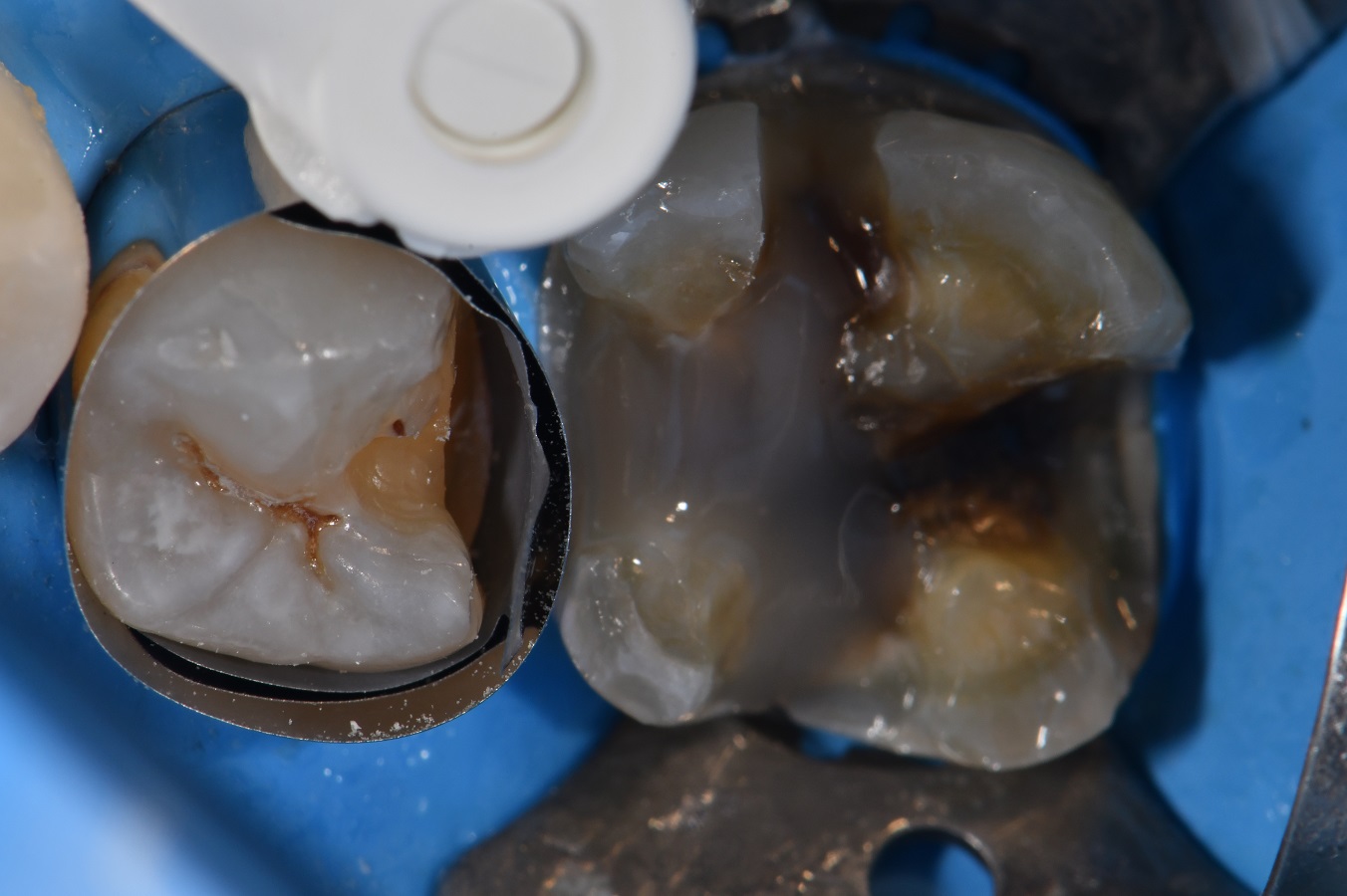 Chasing Cracks in Amalgam-filled teeth