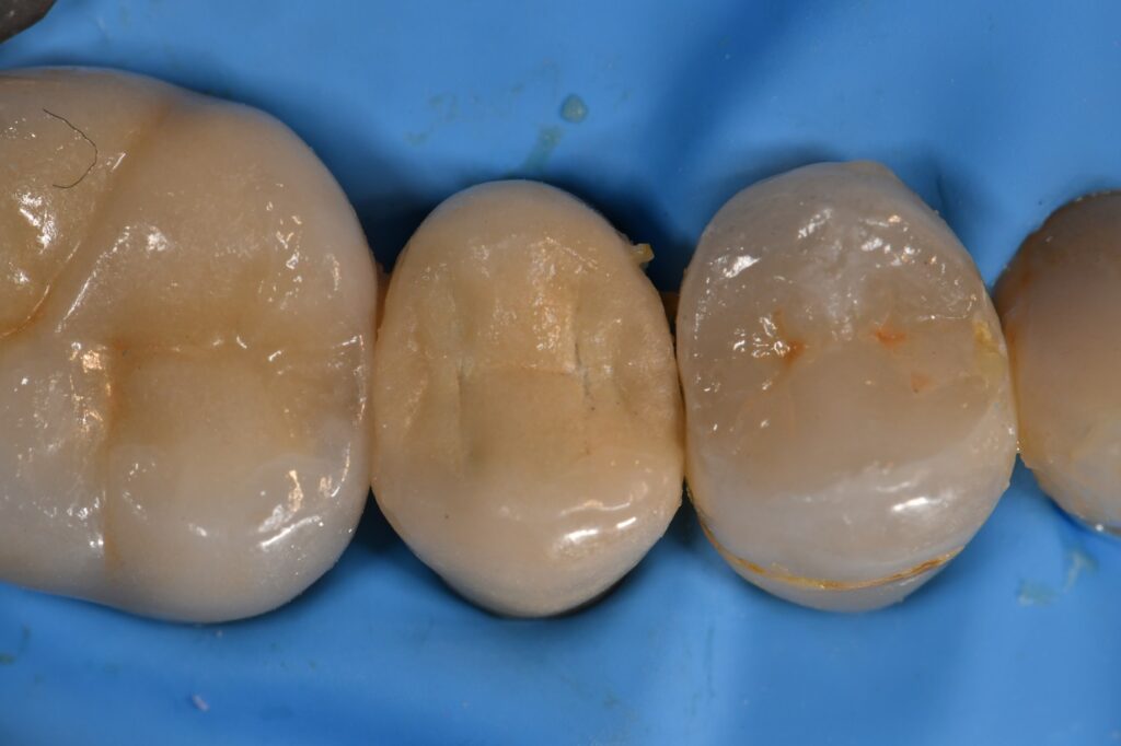 Lithium disilicate is lit