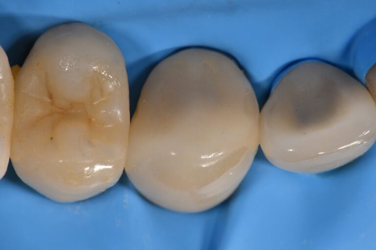 Crown Leakage and Replacement with new bonded porcelain crown