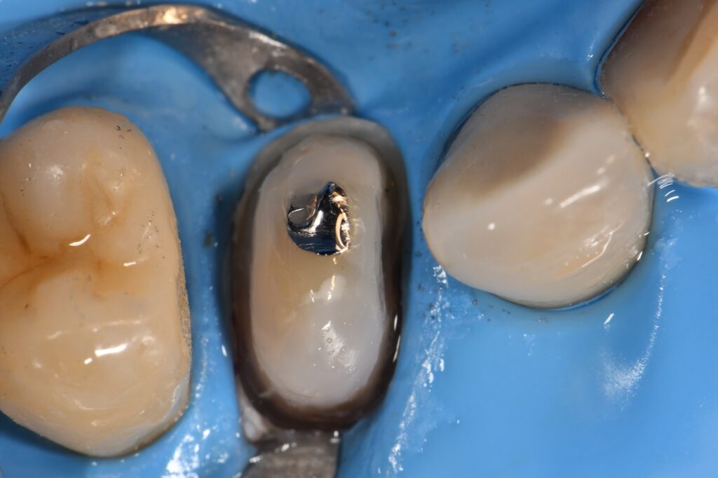 Crown Leakage and Replacement with new bonded porcelain crown