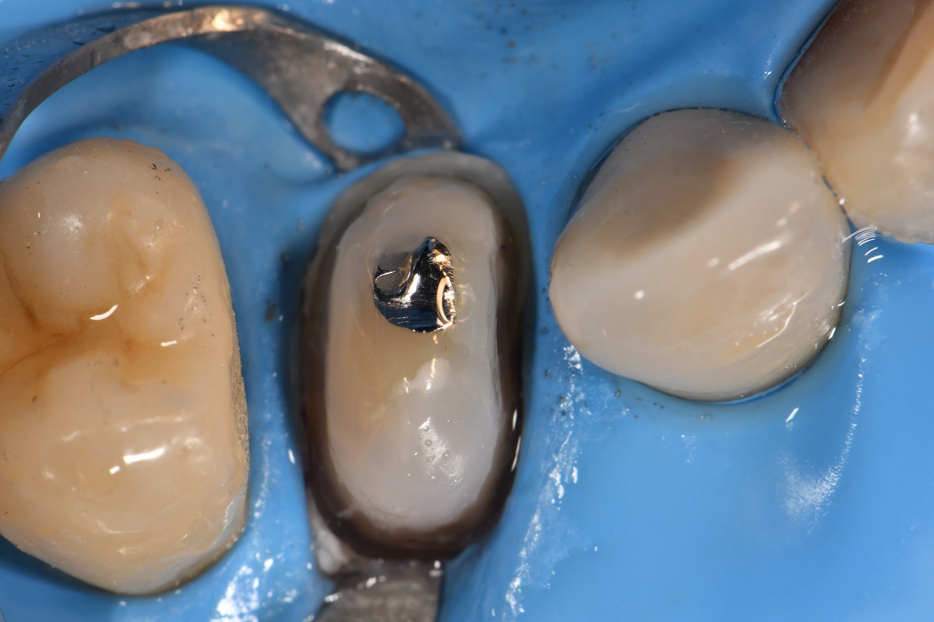 Crown Leakage and Replacement with new bonded porcelain crown