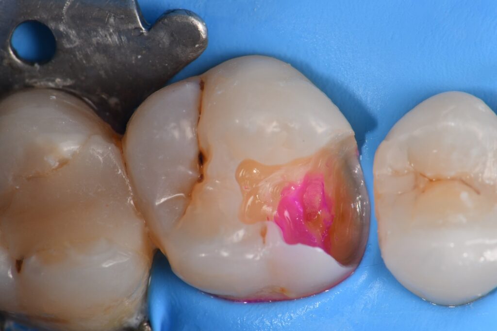 Biomimetic Reconstruction of a broken down tooth
