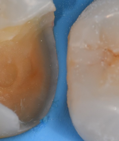 Biomimetic Reconstruction of a broken down tooth